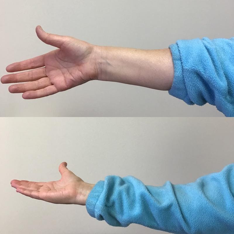 Post Procedure – After the Cast is Gone … - The Bridging Institute